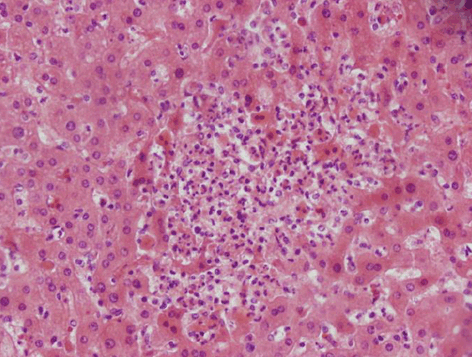 Corynebacterium Minutissimum Gram Stain
