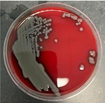 Aeromonas veronii co-infection eye and skin: Case report - Journal of ...